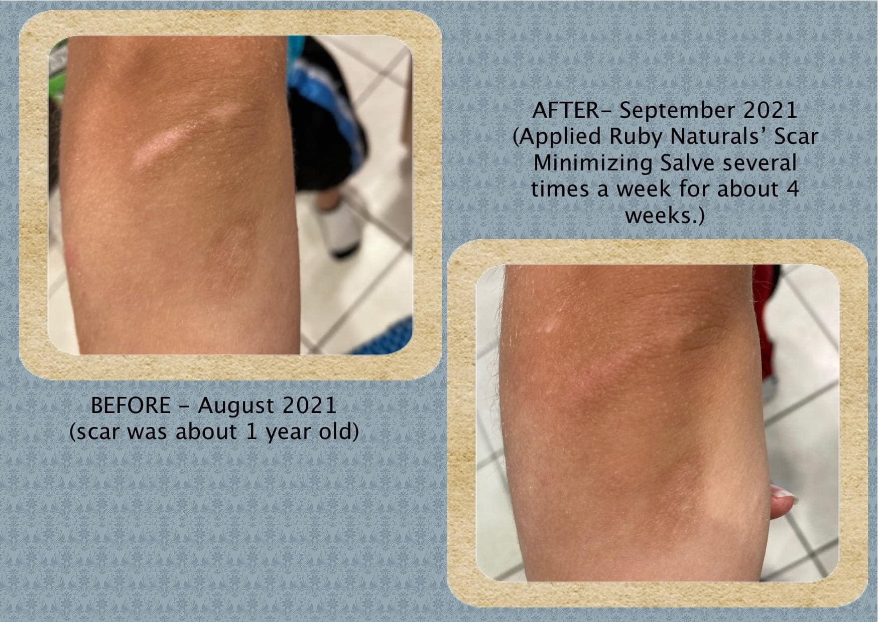 (2 oz.) Scar Minimizing Herbal Salve – Ruby Naturals